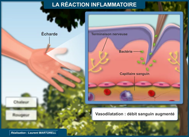 Pod - Réaction Inflammatoire